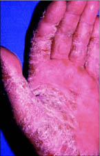 La Processionaria - Informazioni per la salute - Processionaria e cani